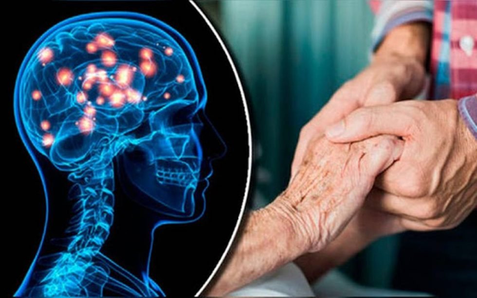 Enfermedad de Huntington - Médicos en Merida